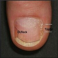 Nagelerkrankungen (Übersicht) Bilder - Altmeyers Enzyklopädie ...