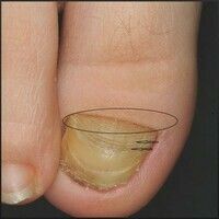 Nagelerkrankungen (Übersicht) Bilder - Altmeyers Enzyklopädie ...