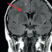 Parry Romberg syndrome Images - Altmeyers Encyclopedia - Department ...