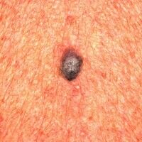 Angiom seniles Bilder - Altmeyers Enzyklopädie - Fachbereich Dermatologie