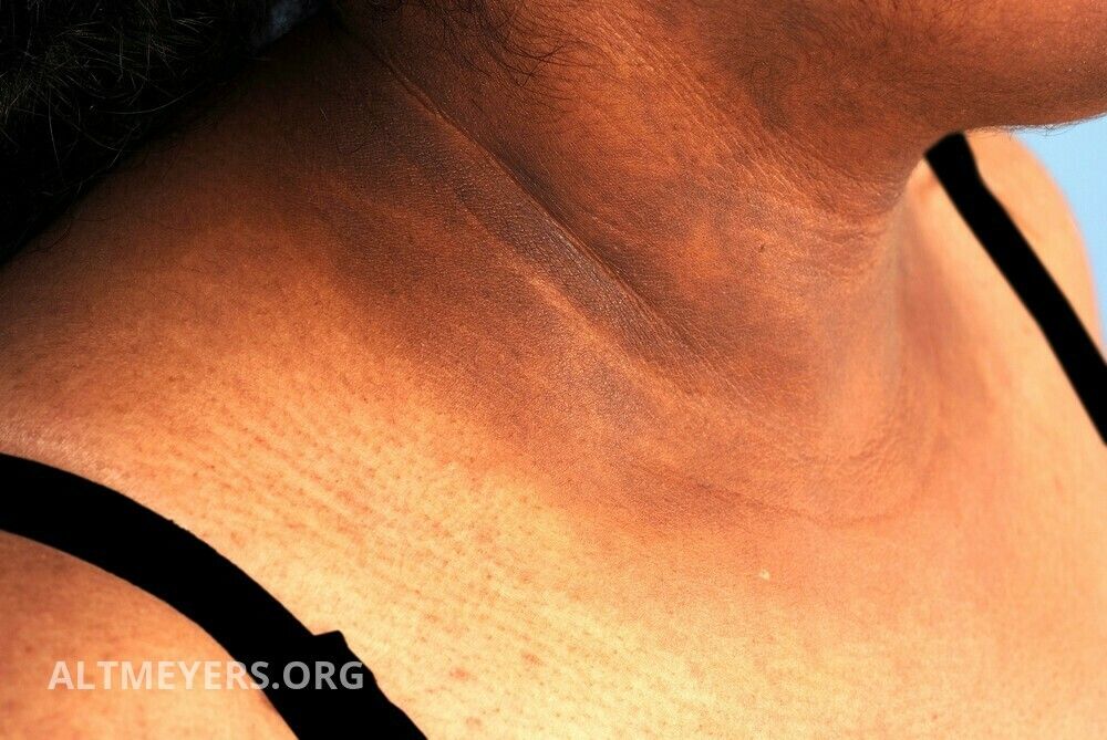 Mild Acanthosis Nigricans Neck