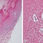 Trachyonychie - Altmeyers Enzyklopädie - Fachbereich Dermatologie