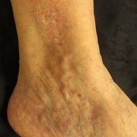 Corona phlebectatica Images - Altmeyers Encyclopedia - Department ...