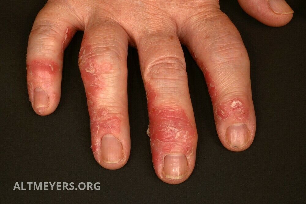 Acrodermatitis Continua Of Hallopeau