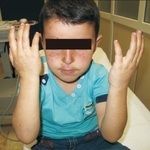 Lichen planus actinicus - Altmeyers Encyclopedia - Department Dermatology