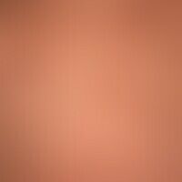 Chronic prurigo Images - Altmeyers Encyclopedia - Department Dermatology