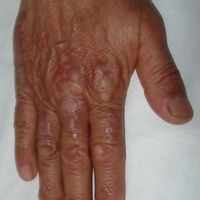 Erythema elevatum diutinum Bilder - Altmeyers Enzyklopädie ...